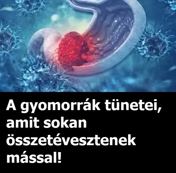 A gyomorrák tünetei, amit sokan összetévesztenek mással!