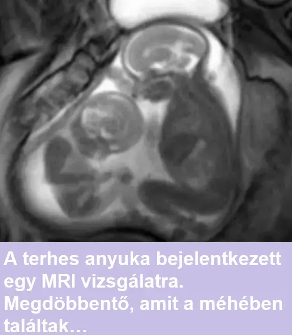 A terhes anyuka bejelentkezett egy MRI vizsgálatra. Megdöbbentő, amit a ...